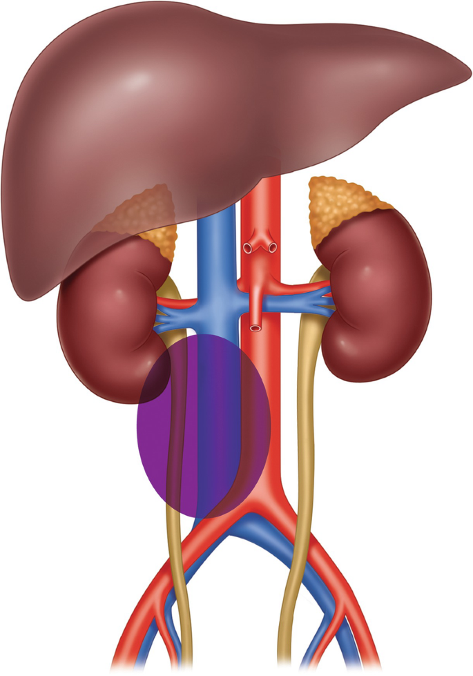 Multidisciplinary Treatment of Paragangliomas in the Lower Abdominal ...