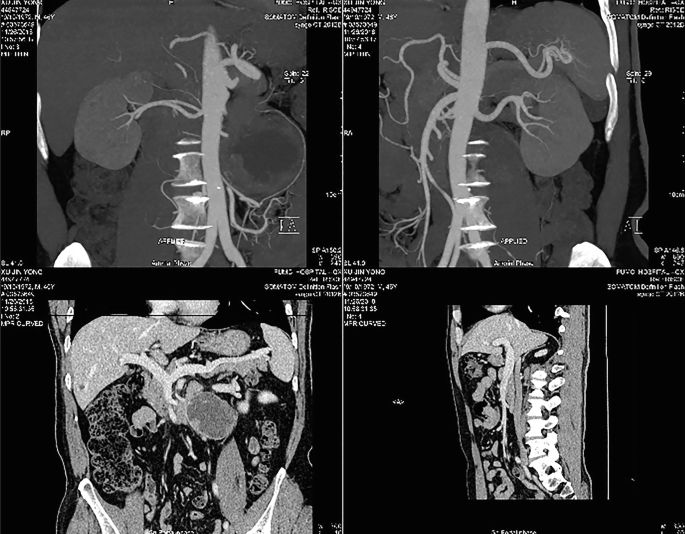 Multidisciplinary Treatment of Paragangliomas in the Lower Abdominal ...