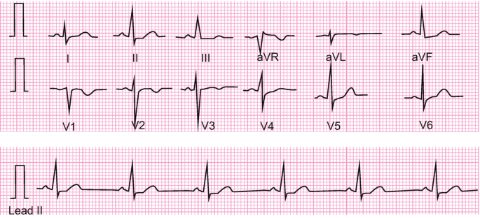 Normal ECG and Its Variants | SpringerLink