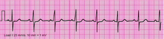 Sinus Rhythm | SpringerLink
