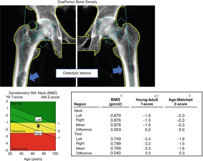 Risk Factors Affecting Bone Mineral Density | Springer Nature Link ...