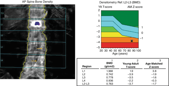 Extraskeletal Causes of Imaging Pitfalls on DXA | SpringerLink