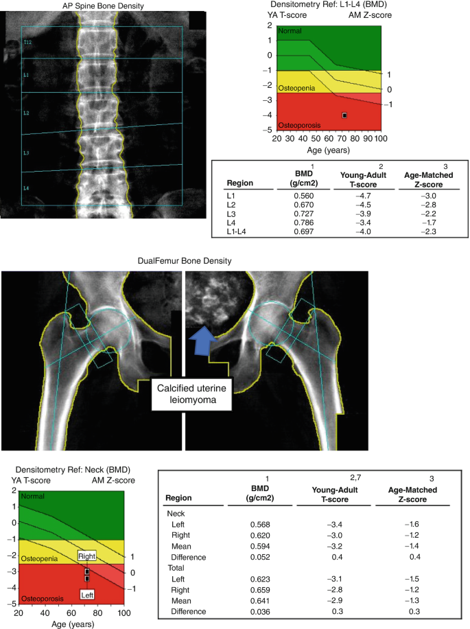 Common Extraskeletal Findings on DXA Studies | Springer Nature Link