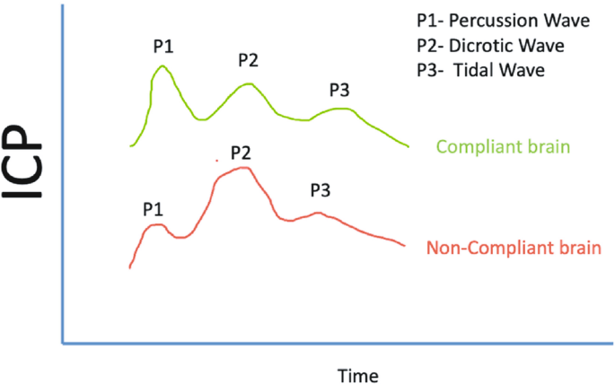 Intracranial Pressure Monitoring in Traumatic Brain Injury | SpringerLink