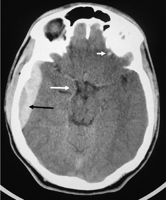 Radiology and Imaging in Neurotrauma | SpringerLink
