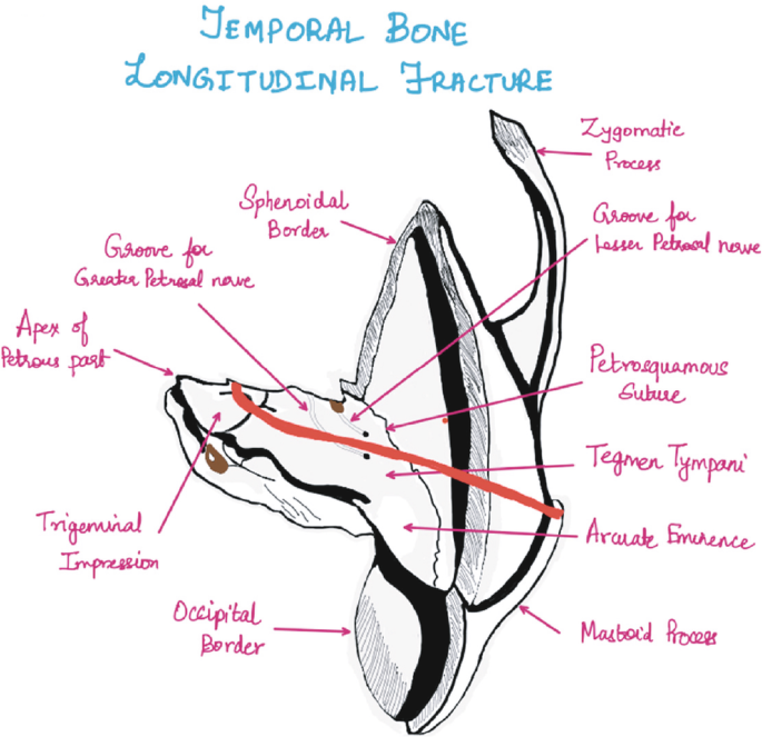 Temporal Bone Fractures | SpringerLink