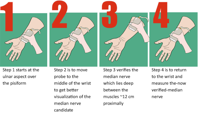 Volar Aspect Of Wrist Hand Therapy Academy | TFCC . There Are