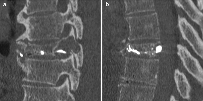 Dorsal Collapse in Multiple Myeloma Vertebroplasty | SpringerLink