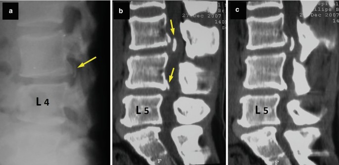 Posterior Longitudinal Ligament Ossifications | SpringerLink