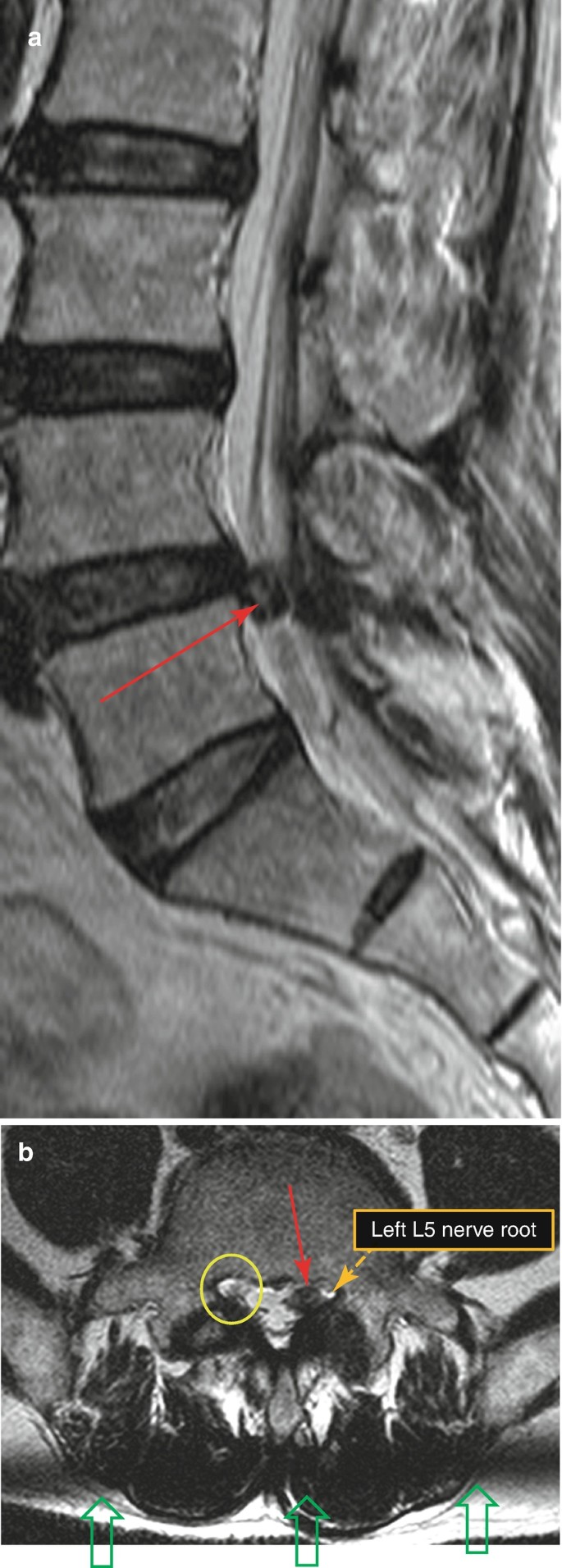 Common Spine Disorders Associated with Back Pain | SpringerLink