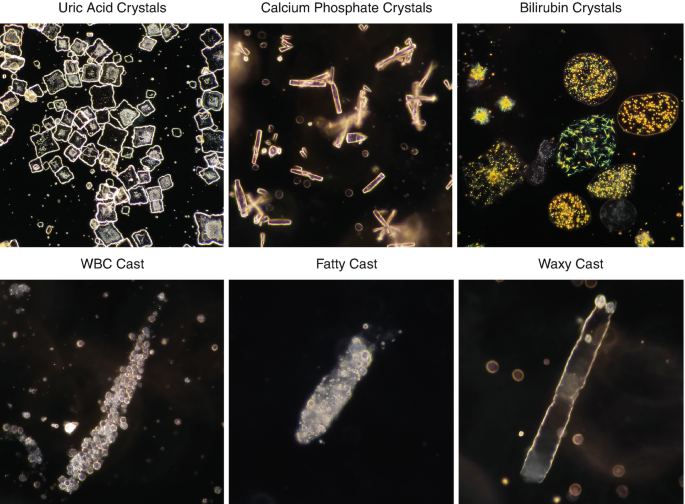 Analysis of Urine-Formed Elements: Overview | SpringerLink