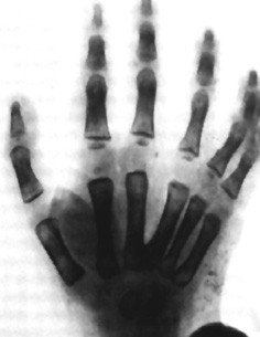 Polydactyly | SpringerLink