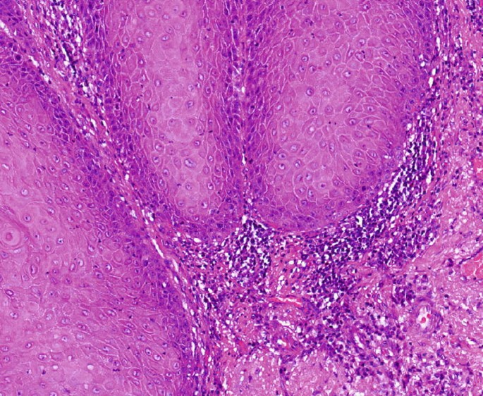 Penile Verrucous Carcinoma | SpringerLink