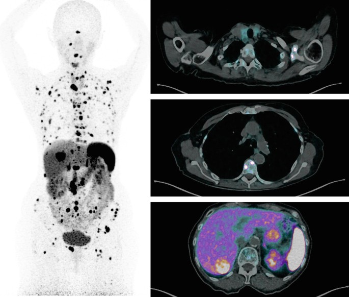Gallium-68-DOTA-NOC/-TOC/TATE PET/CT | Springer Nature Link (formally ...