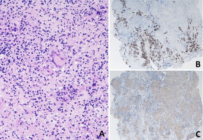 Hypophysitis | SpringerLink