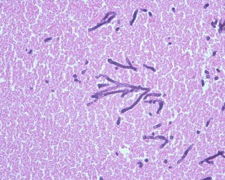 Fusariosis | Springer Nature Link