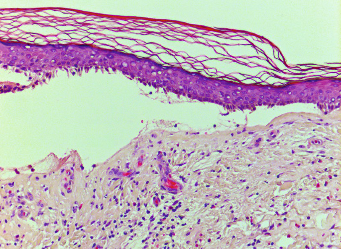 Pemphigoid, Bullous, Esophageal | SpringerLink