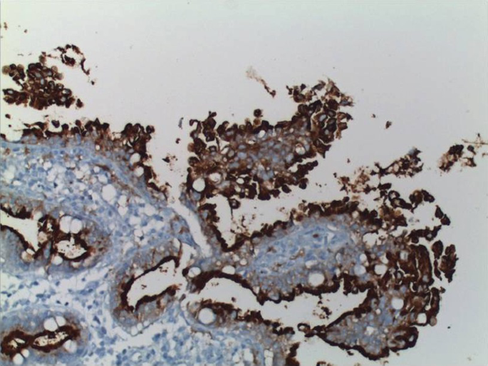 Tufting Enteropathy | SpringerLink