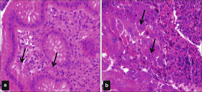 Viral Colitis | SpringerLink