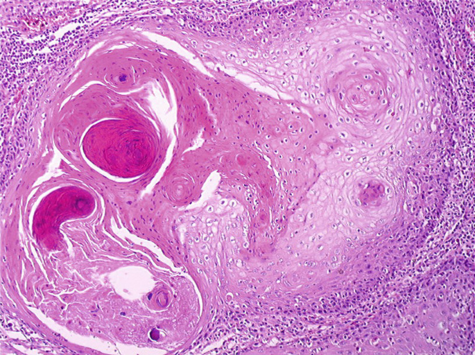 Verrucous Carcinoma/Giant Condyloma of Buschke and Löwenstein ...