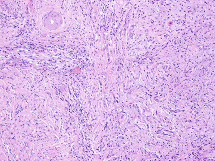 Inflammatory Myofibroblastic Tumor, Upper Gastrointestinal Tract ...