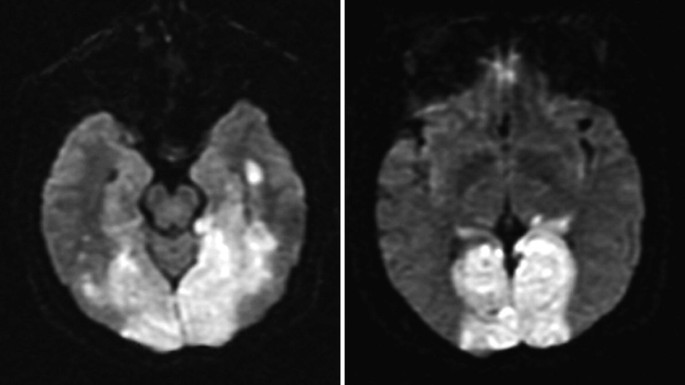 Cortical Blindness | SpringerLink