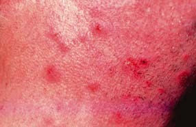 Sycosis barbae | SpringerLink