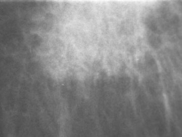 Breast, Benign Tumors | SpringerLink