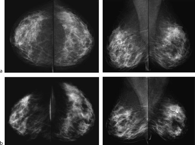 Carcinoma, Lobular, Invasive | SpringerLink