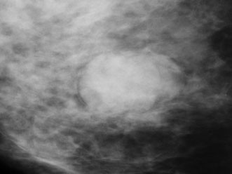 Cyst, Breast | Springer Nature Link