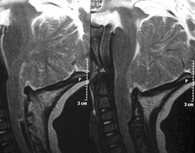 Arnold-Chiari-Malformationen | Springer Nature Link