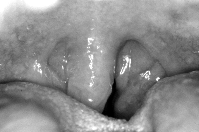 Uvulopalatopharyngoplastik | SpringerLink