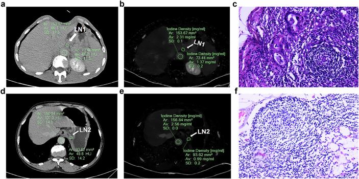 Correction: Spectral computed tomography-based quantitative parameters ...