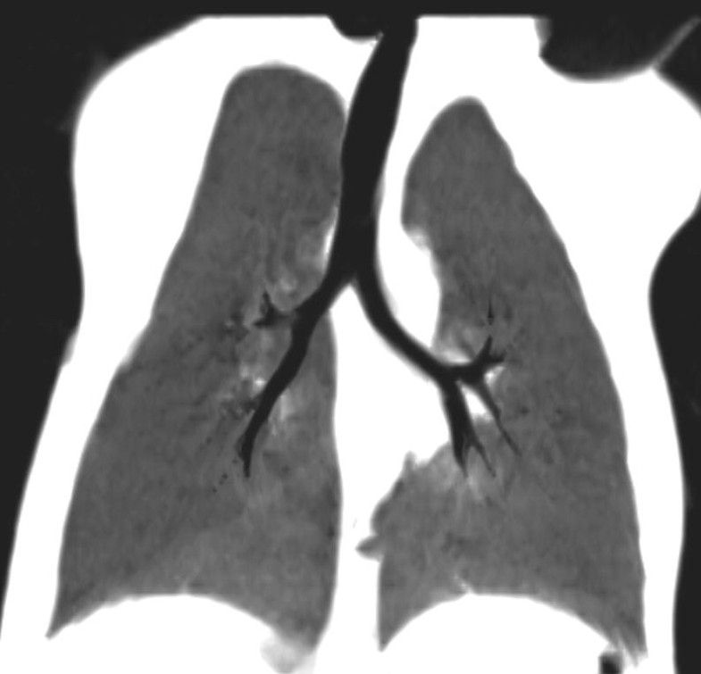 Multi-detector thoracic CT findings in cerebro-costo-mandibular ...