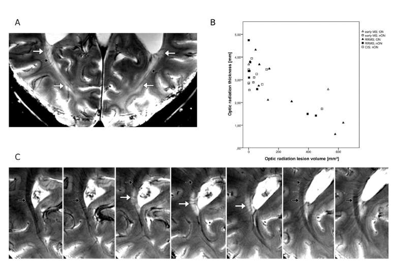 Optic radiation damage in multiple sclerosis is associated with visual ...