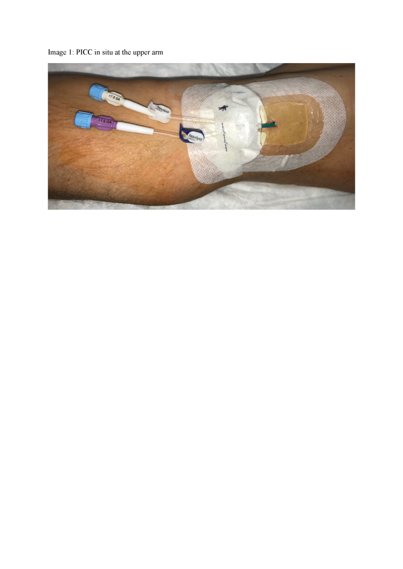 Peripherally inserted central venous catheter (PICC) in outpatient and ...