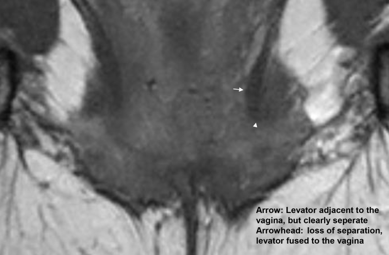 Levels of pelvic floor support: what do they look like on magnetic ...