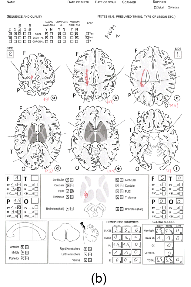 Optimization of MRI-based scoring scales of brain injury severity in ...