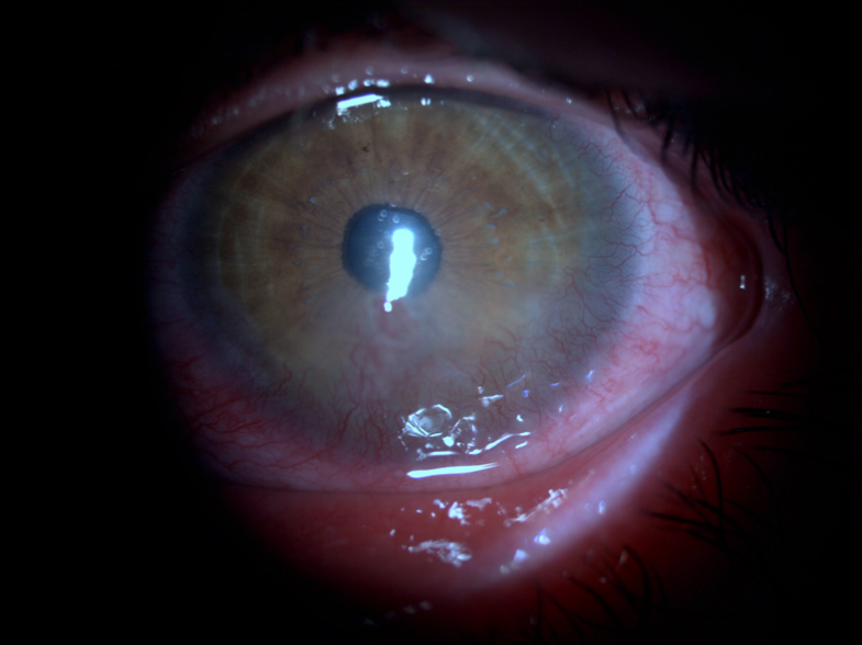 Successful treatment of staphylococcus-associated marginal keratitis ...