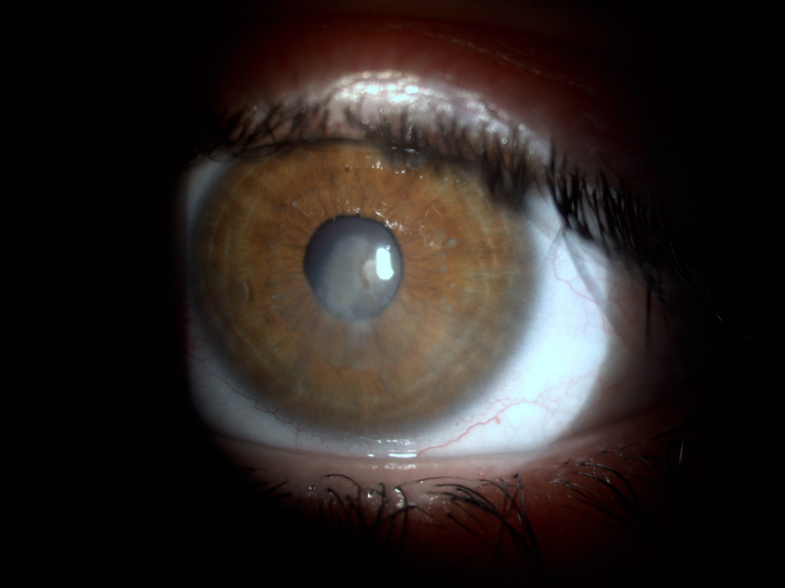 Successful treatment of staphylococcus-associated marginal keratitis ...