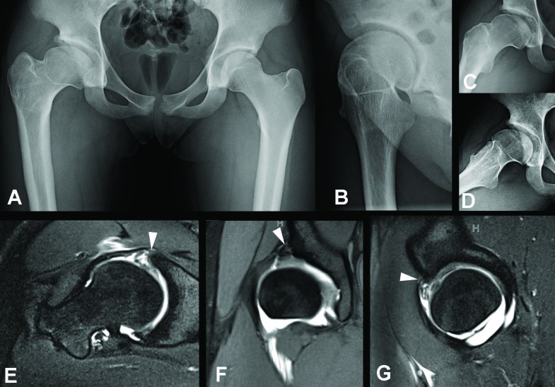 Surgical Dislocation of the Hip: Evolving Indications | SpringerLink