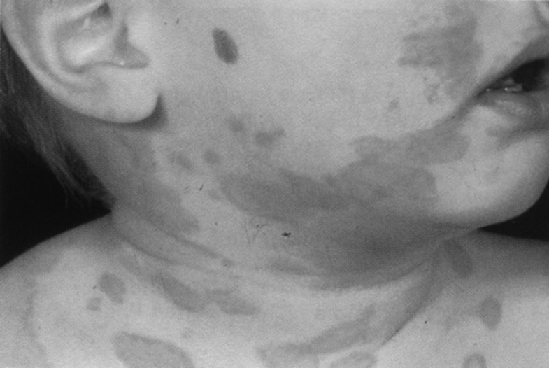 Huiduitslag bij kinderen | SpringerLink