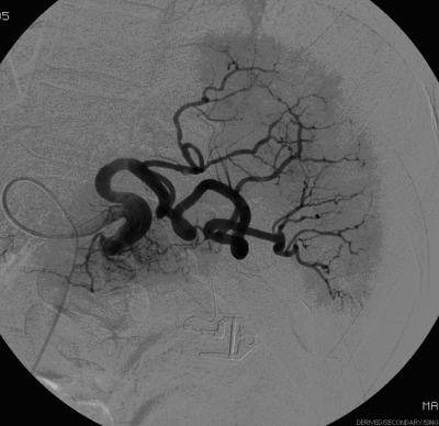 Coilembolisatie van een traumatische miltruptuur | SpringerLink