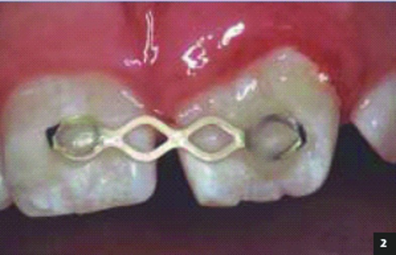 Titanium Trauma Splint (TTS) bij tandletsel | SpringerLink