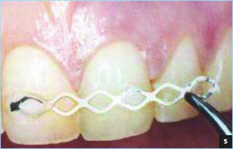 Titanium Trauma Splint (TTS) bij tandletsel | SpringerLink