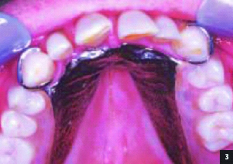 De partiële frameprothese en het parodontium | SpringerLink