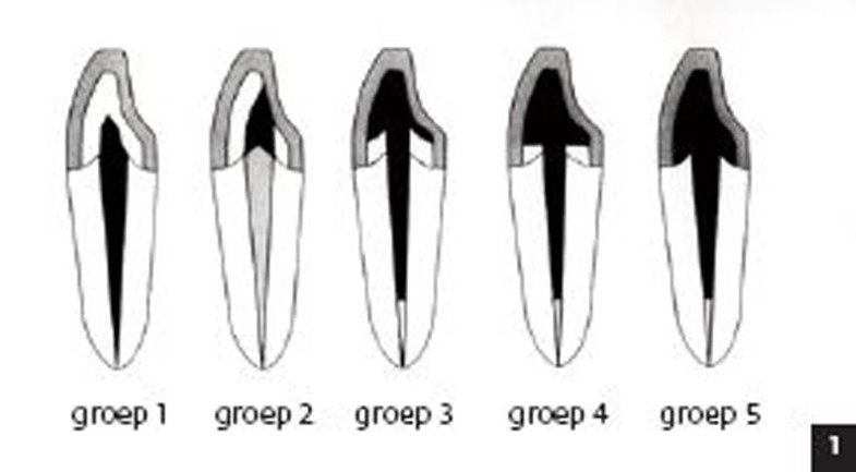 De ferrule-rule aan de tand gevoeld | SpringerLink