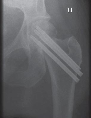 Ernstige complicatie van gecannuleerde heupschroeven bij mediale ...