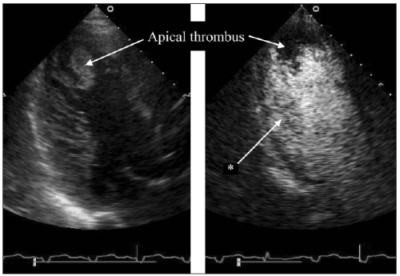 Clinical usefulness of SonoVue contrast echocardiography: the ...