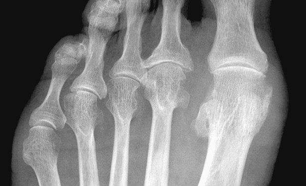 Artrose en artritis: de radiologische kant van een ziektebeeld ...